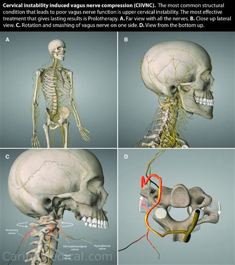 What Is Compression In The Neck At Gabriel Faulkner Blog