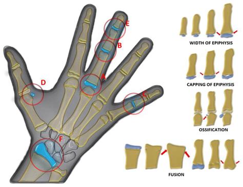 Evaluation Of The First Metacarpal Bone Head And Distal Radius Bone Architecture Using Fractal