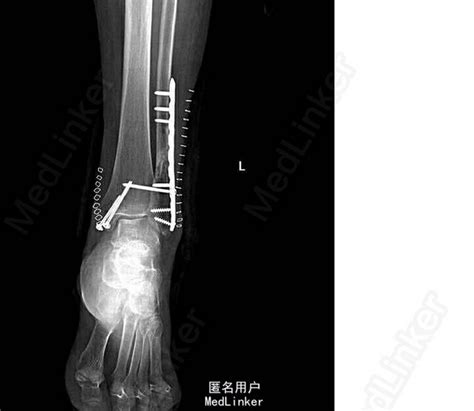 左踝关节骨折脱位 医联