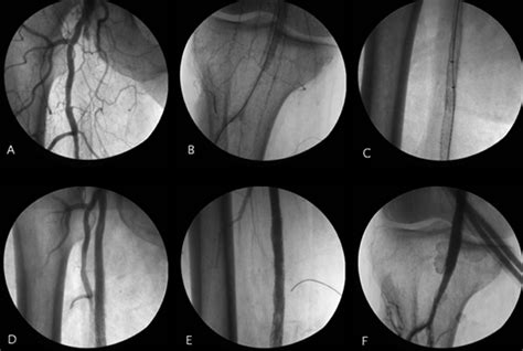 Proximal Thrombotic Occlusion Of The Left Superficial Femoral Artery Download Scientific