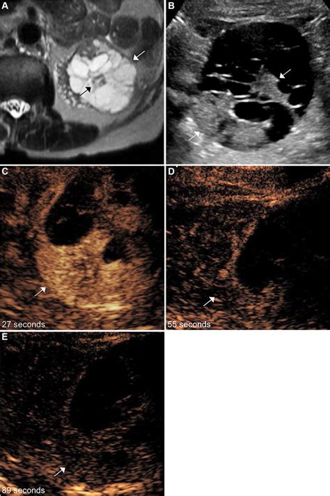 A 68 Year Old Female With Chronic Renal Insufficiency And A Left Renal Download Scientific