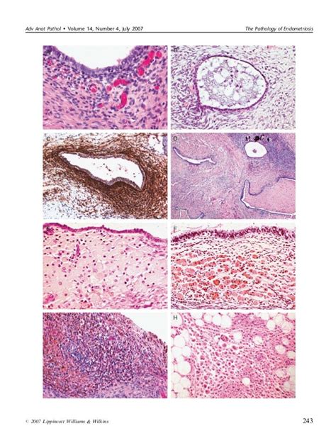 Pathology Outlines Endometriosis