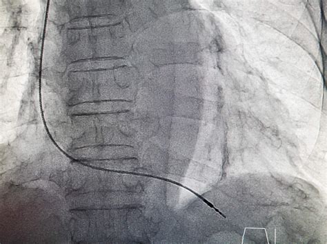 Technical Factors In Cardiac Ep Ablation Procedures