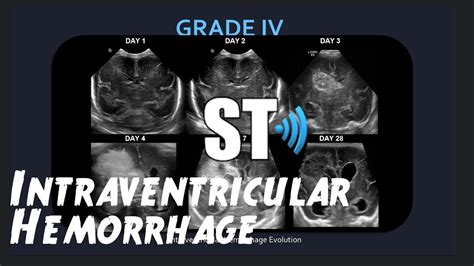 Intraventricular Hemorrhage Neonatal Ivh Brain Bleed Youtube