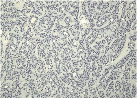Histopathology Showed A Cellular Monomorphic Basaloid Tumor With Download Scientific Diagram