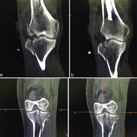 Pdf Multi Detector Computed Tomographic Evaluation Of Tibial Plateau Fractures With Review Of