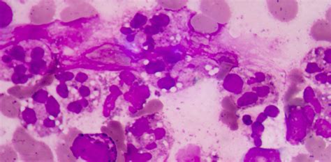 Genomics Has Helped Identify A New Strep A Strain In Australia And What Has Made It Dangerous