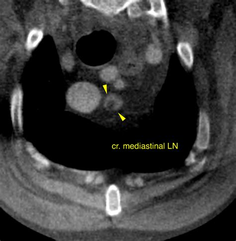 Ct Disseminated Cylindrical Peripheral Bronchiectasis Without