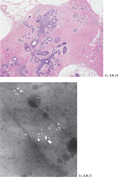 Multiple Clusters Of Crushed Stone Like Calcifications On The Mammogram Produced By Malignant