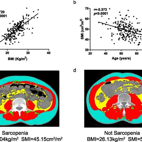 The Correlation Between Patients L3 Smi And Bmi L3 Smi And Age Smi Download Scientific