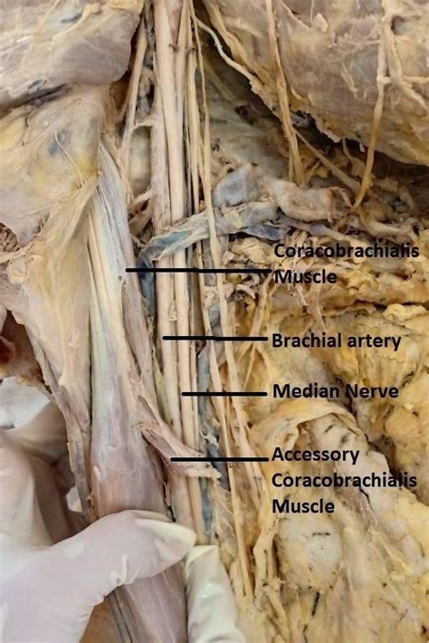 Showing Coracobrachialis Muscle Accessory Belly Of Coracobrachialis Download Scientific