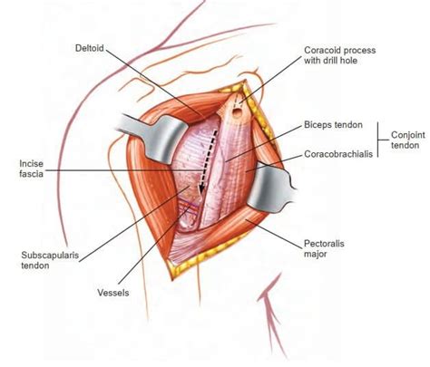 Shoulder Deltopectoral Approach Orthofixar 2025