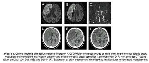 Successful Management Of Massive Anterior Middle Cerebral Artery Territory Stroke With Catheter