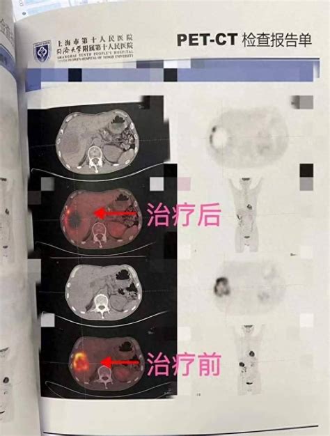一年间确诊癌症晚期，两个月峰回路转→田大叔患者治疗