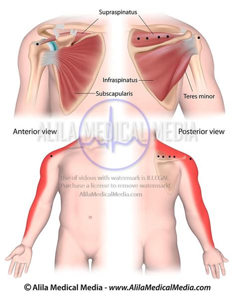 Alila Medical Media Trigger Points And Referred Pain Patterns For The Supraspinatus Medical