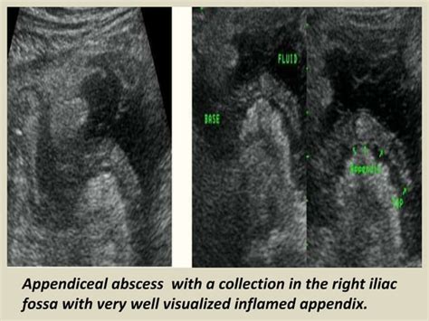 Presentation1 Pptx Ultrasound Examination Of The Appendix Pptx