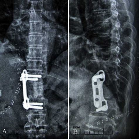 A And B Anteroposterior And Lateral Radiograph Of Thoracic Vertebra Download Scientific