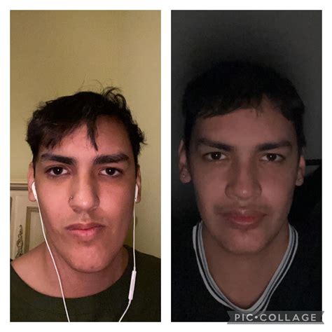 Not Only Did Jaw Surgery Correct Jaw Asymmetry But It Also Corrected My Prior Eye Asymmetry As