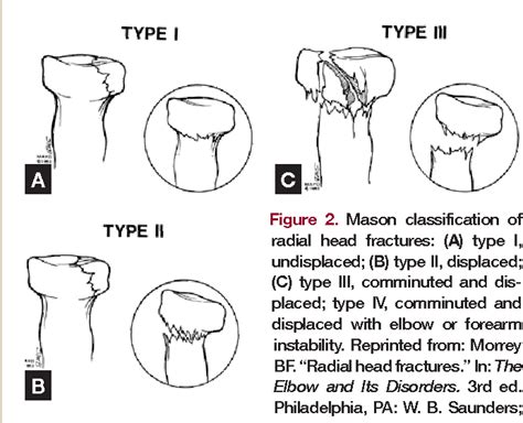 Mason Classification Radial Head