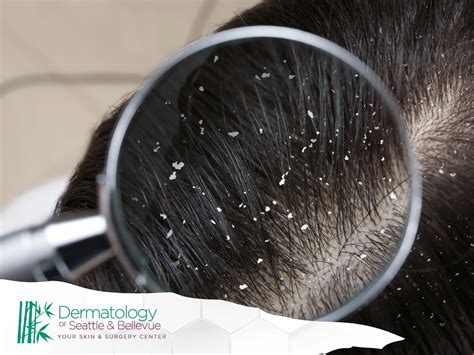 Flakes On Your Scalp Dandruff Causes Treatments And When It Could Be Psoriasis Dermatology