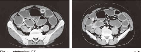 Figure 1 From A Case Of Goblet Cell Carcinoid Of Appendix Which The Laparoscopic Evaluation