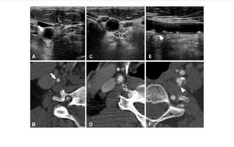 Imaging Of The Carotid Artery Vulnerable Plaque Pdf Download Available