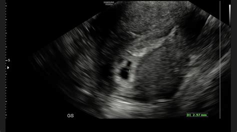 Miscarriage Or Subchorionic Hematoma 6 Weeks Pregnant R Pregnancy Care