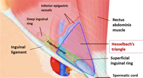 Hesselbachs Triangle