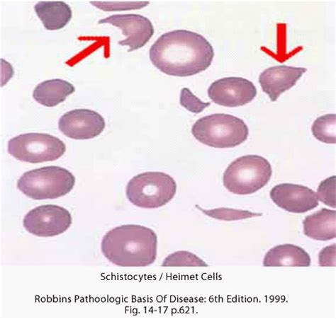 Schistocytes On Peripheral Smear