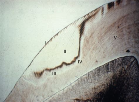 Histology Enamel Caries Diagram Quizlet