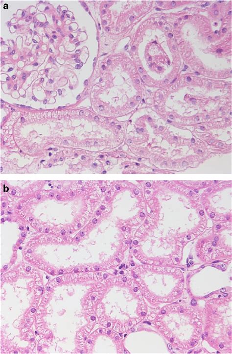 Normal Glomerulus