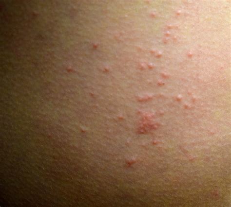 Beginning Stages Of Scabies