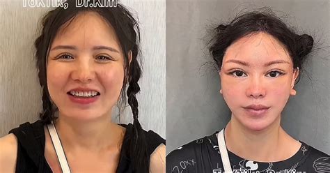 역대급 성형 얼굴 전후 사진에 의사들도 발칵 뭘 했길래