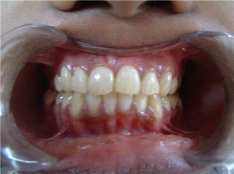 Post Operative Occlusion Download Scientific Diagram