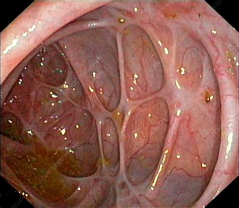 Ulcerative Colitis Scars Endoscope View Stock Image C0339791 Science Photo Library