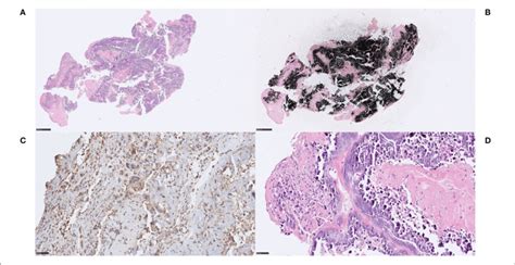 Extracellular Dna Ecdna With Calcifications Microcalcific Type Download Scientific