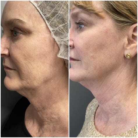 Sofwave Dermatologist In Lake Forest Ca Saddleback Dermatology