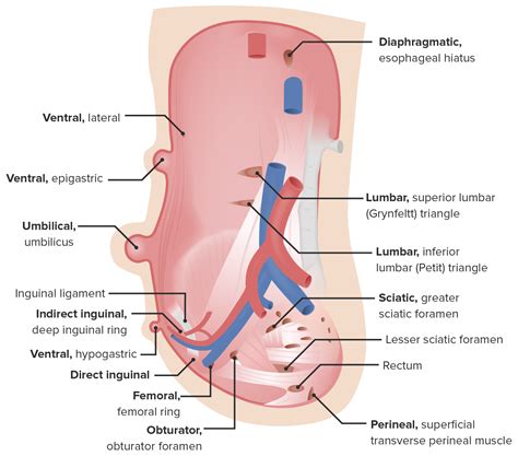 Abdominal Hernias Concise Medical Knowledge
