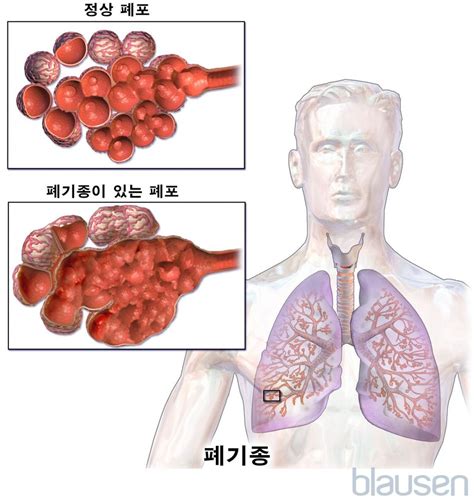 만성 폐쇄성 폐질환copd 만성 폐쇄성 폐질환copd Msd 매뉴얼 일반인용