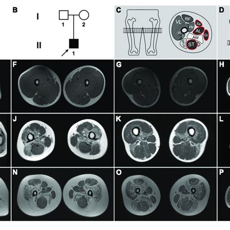 pathogenic sgcb variants identified in our patients with download