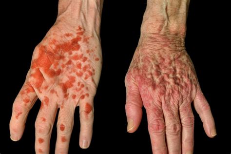 Eczema Vs Psoriasis