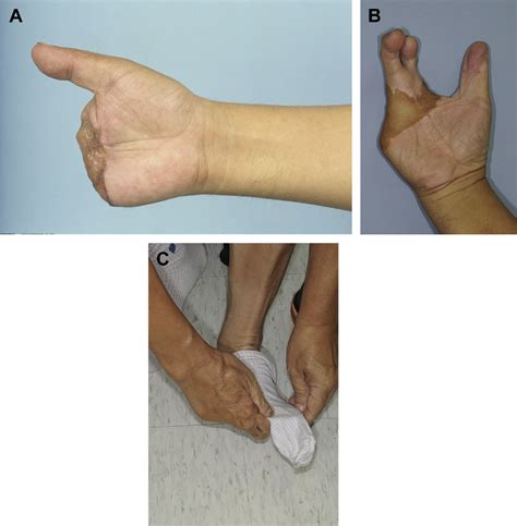 Figure 1 From Metacarpal Like And Metacarpal Hand Semantic Scholar