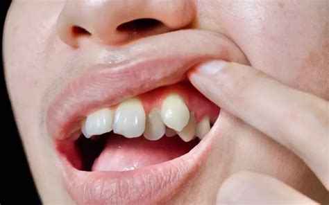 How To Fix A Snaggle Tooth Causes And Treatment Options Dental Health