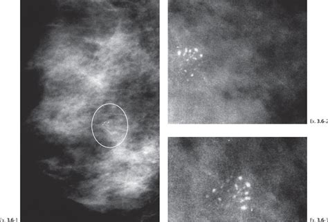 Multiple Clusters Of Crushed Stone Like Calcifications On The Mammogram Produced By Malignant