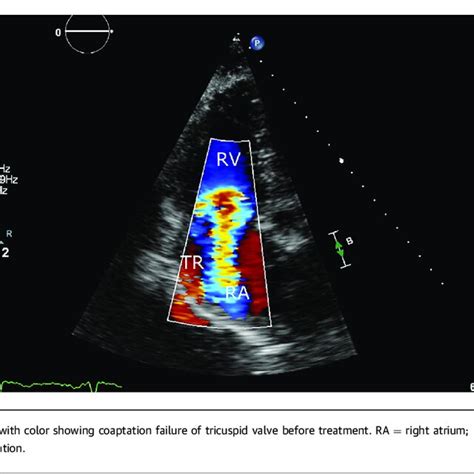 2 Dimensional Transthoracic Echocardiography Download Scientific Diagram