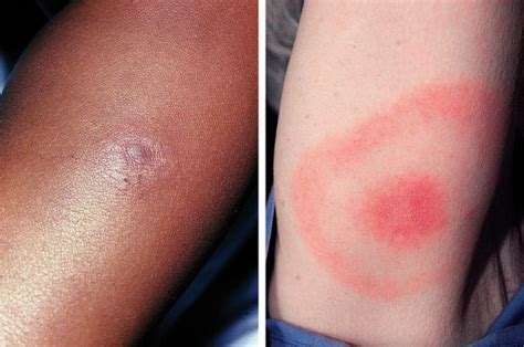 Lyme Disease Uk Lyme Disease And The Em Rash