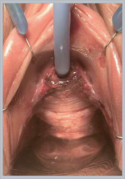 A Vaginal Physical Exam At Time Of Initial Cystoscopy A Foley