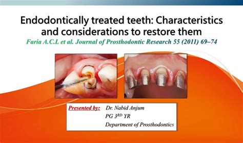 Rehabilitation Of Endodontically Treated Teeth Post And Core Pptx