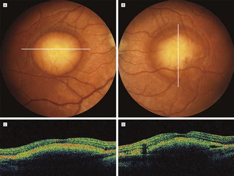 Best Vitelliform Macular Dystrophy A And B Fundus Shows Well Demarcated Vitelliform Lesions In