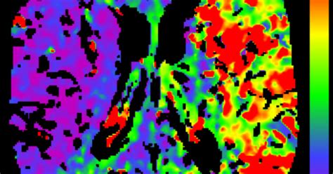 Detects Cerebral Stroke Using Artificial Intelligence University Of Stavanger